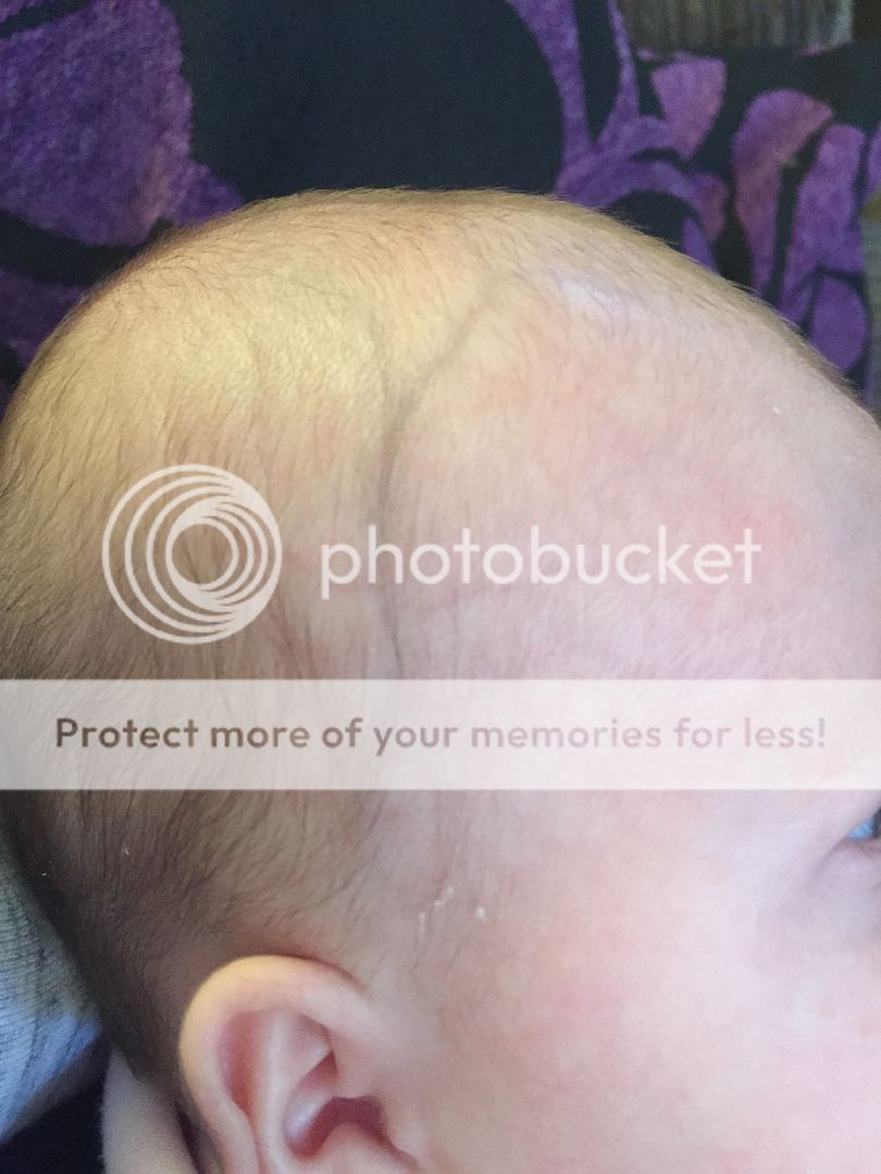 Veins on baby's head?? | BabyCentre